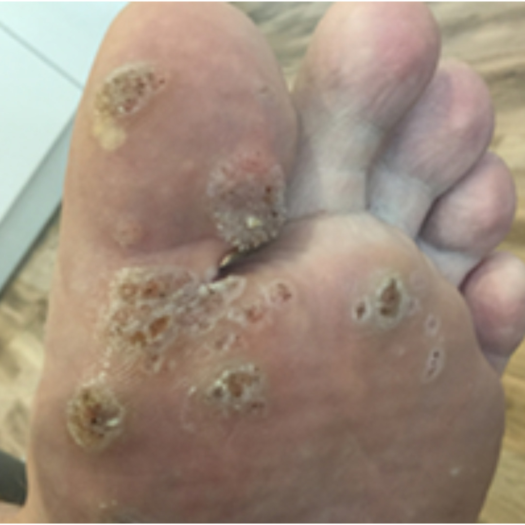 Verruca removal | Podiatrist verruca treatment | Hatt Clinic
